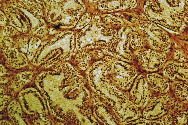 Potted Pathology Part 3: Cancer | Data Thistle